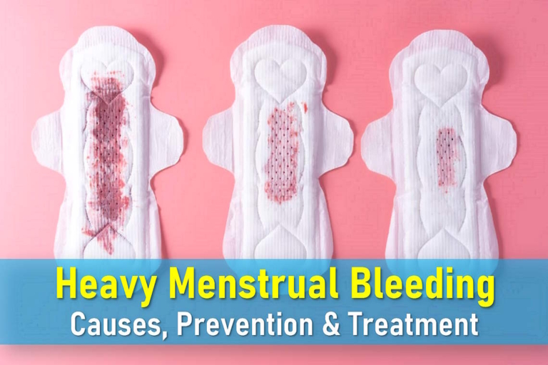 Heavy Menstrual Bleeding ( Menorrhagia ): Causes, Treatment